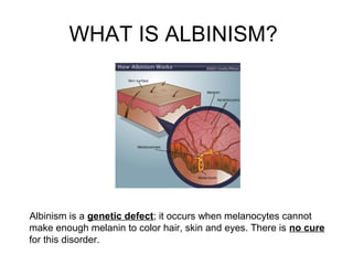 Albinism | PPT