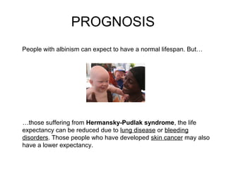 Albinism | PPT