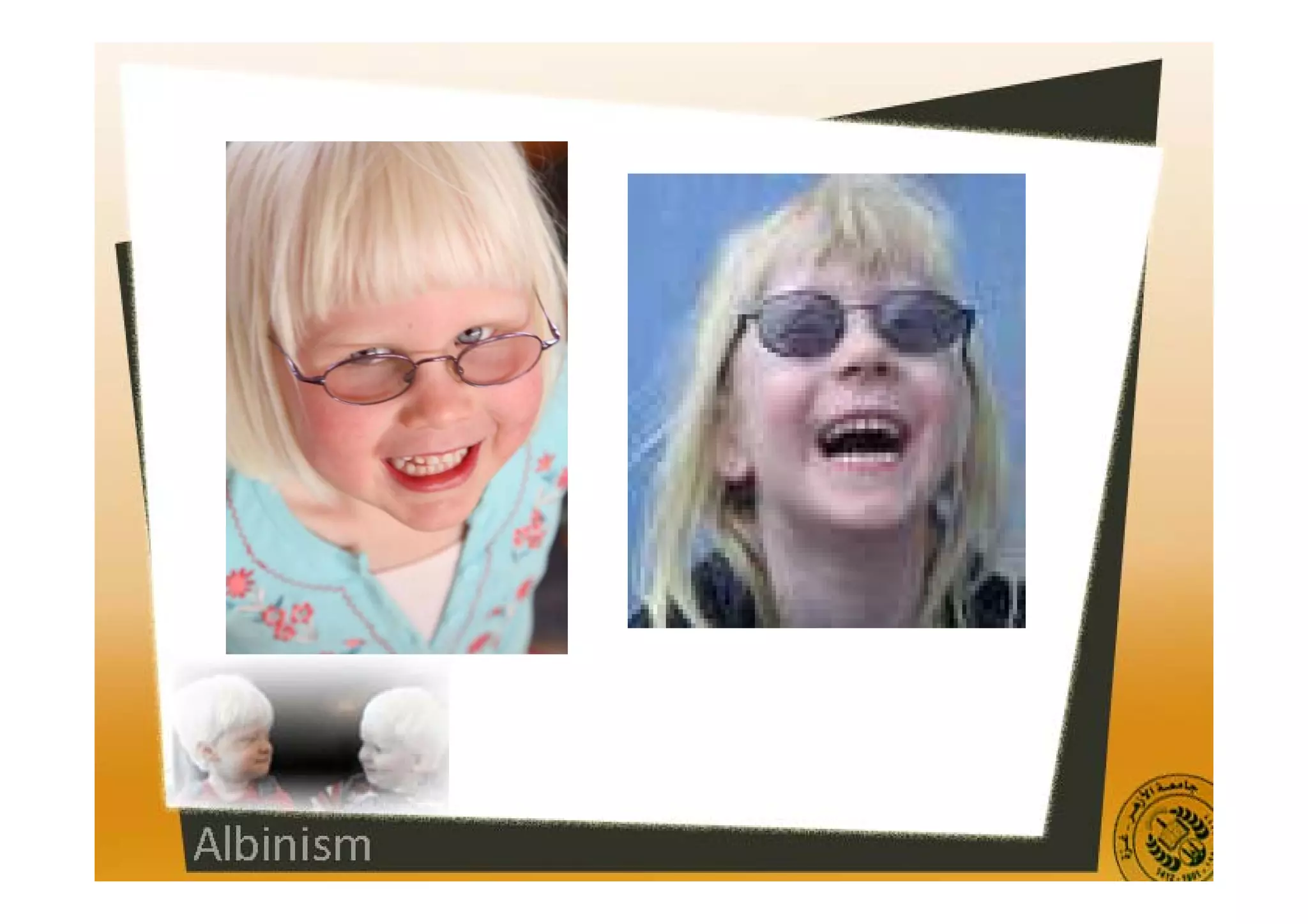 Albinism | PDF | Eye and Vision Conditions | Diseases and Conditions