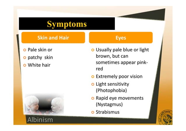 Albinism | PDF | Eye and Vision Conditions | Diseases and Conditions