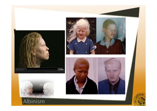 Albinism | PDF | Eye and Vision Conditions | Diseases and Conditions