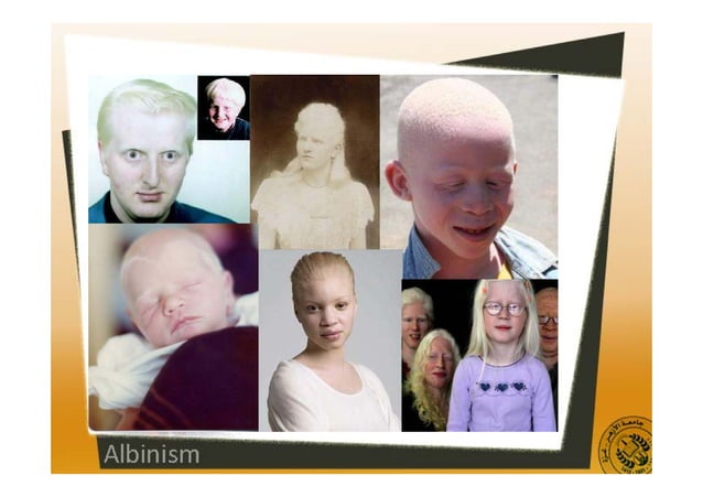 Albinism | PDF | Eye and Vision Conditions | Diseases and Conditions