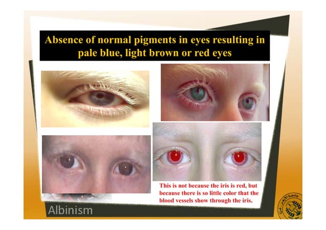 Albinism | PDF | Eye and Vision Conditions | Diseases and Conditions