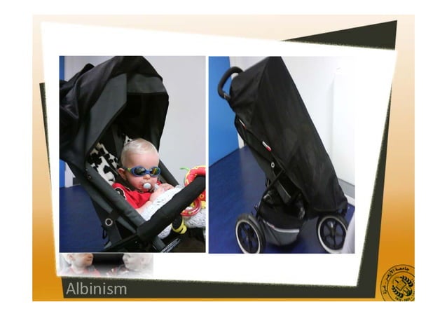 Albinism | PDF | Eye and Vision Conditions | Diseases and Conditions