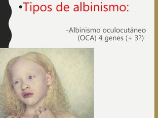 Albinismo | PPTX