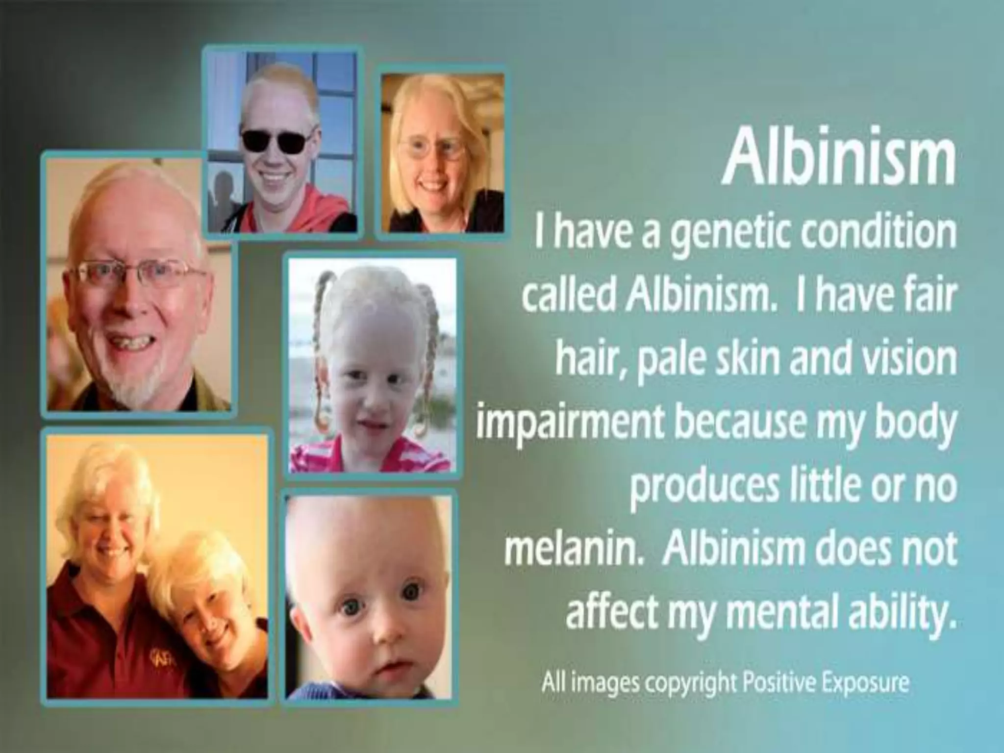 Albinism presantation | PPTX
