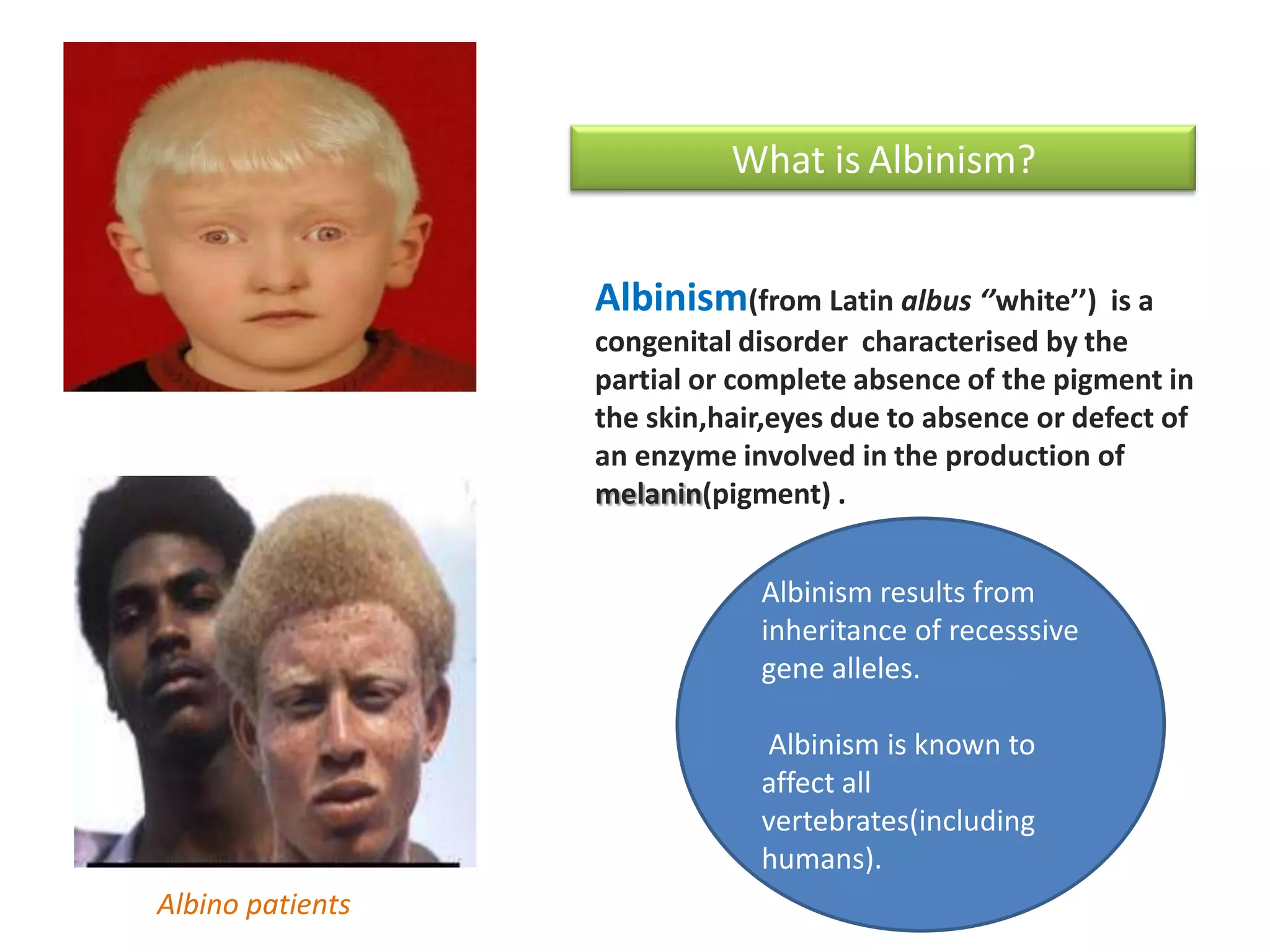 Albinism presantation | PPTX