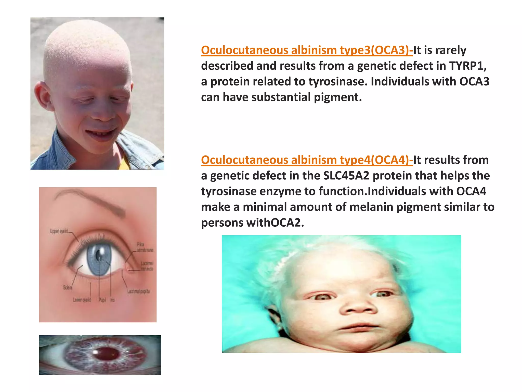 Albinism presantation | PPTX