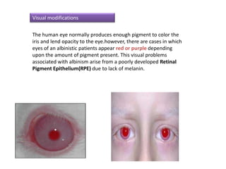 Albinism presantation | PPTX