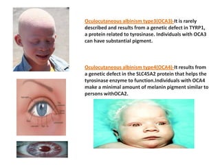 Albinism presantation | PPTX