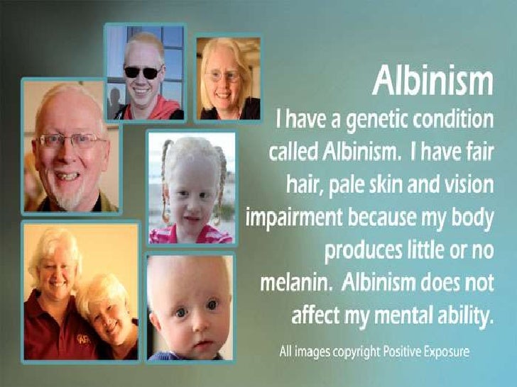 Albinism presantation