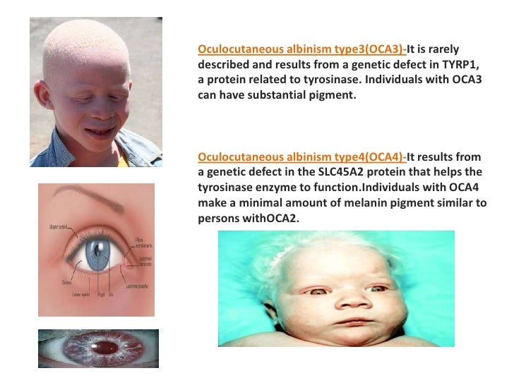 Oculocutaneous Albinism Type 4