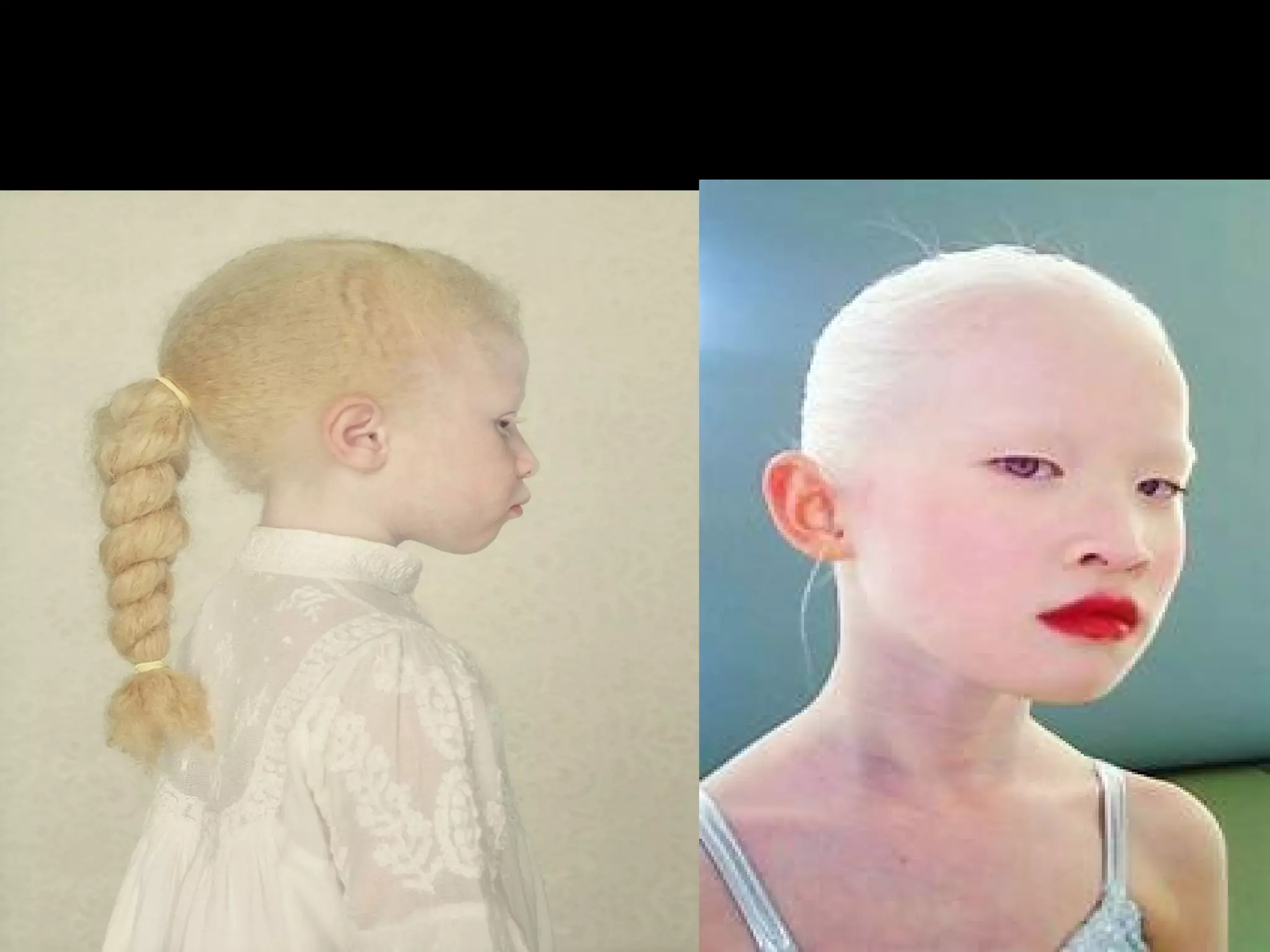 albinism | PPT