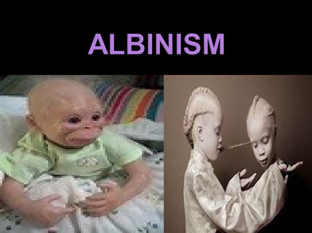albinism | PPT