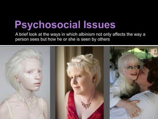 albinism | PPT