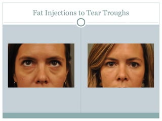 Before and After Photos of Facial Implants and Fat Grafting at Changes ...