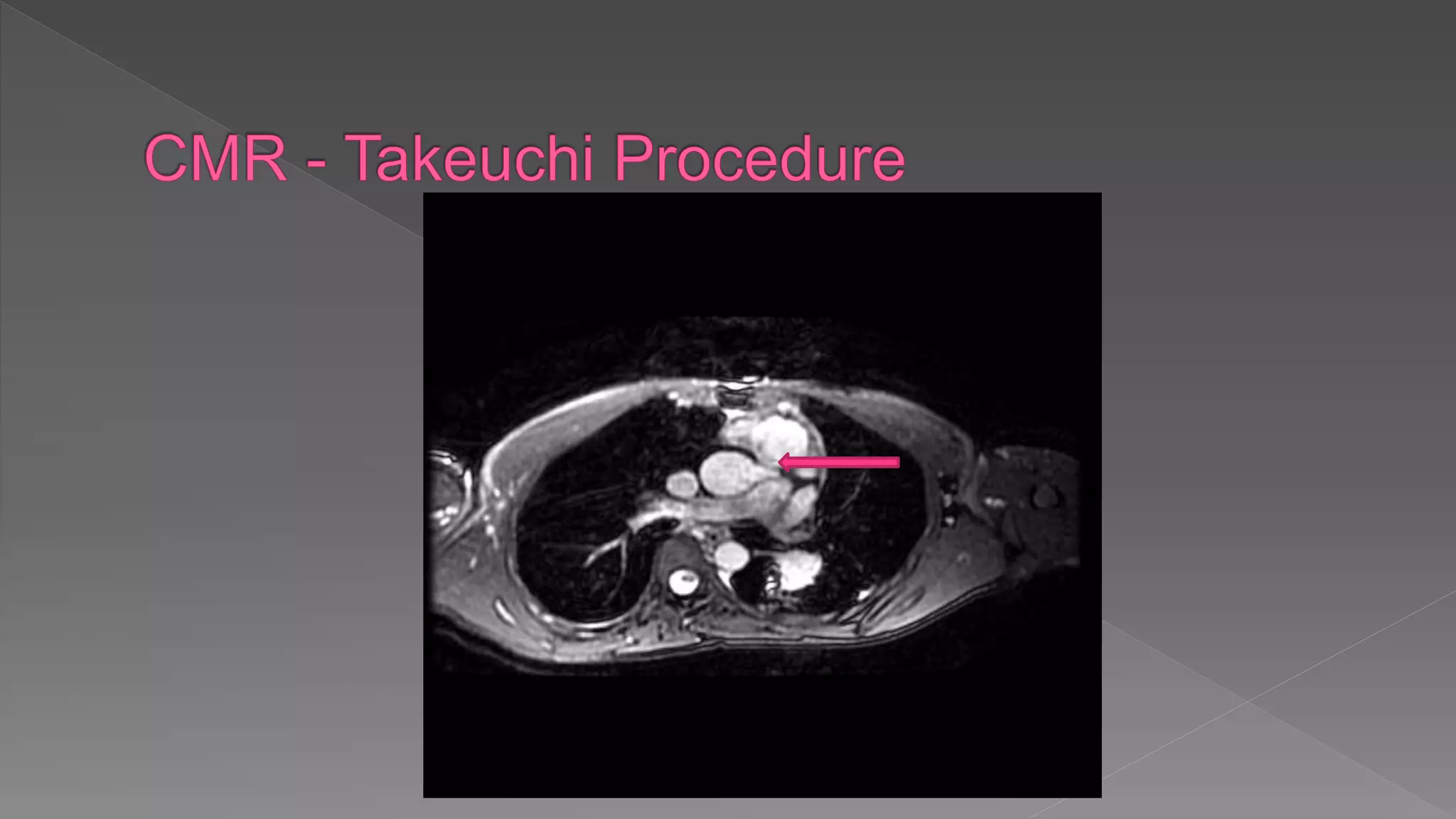 ALCAPA AND TAKEUCHI PROCEDURE | PPTX | Heart and Cardiovascular ...