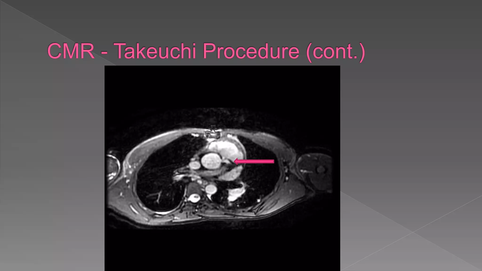 ALCAPA AND TAKEUCHI PROCEDURE | PPTX | Heart and Cardiovascular ...