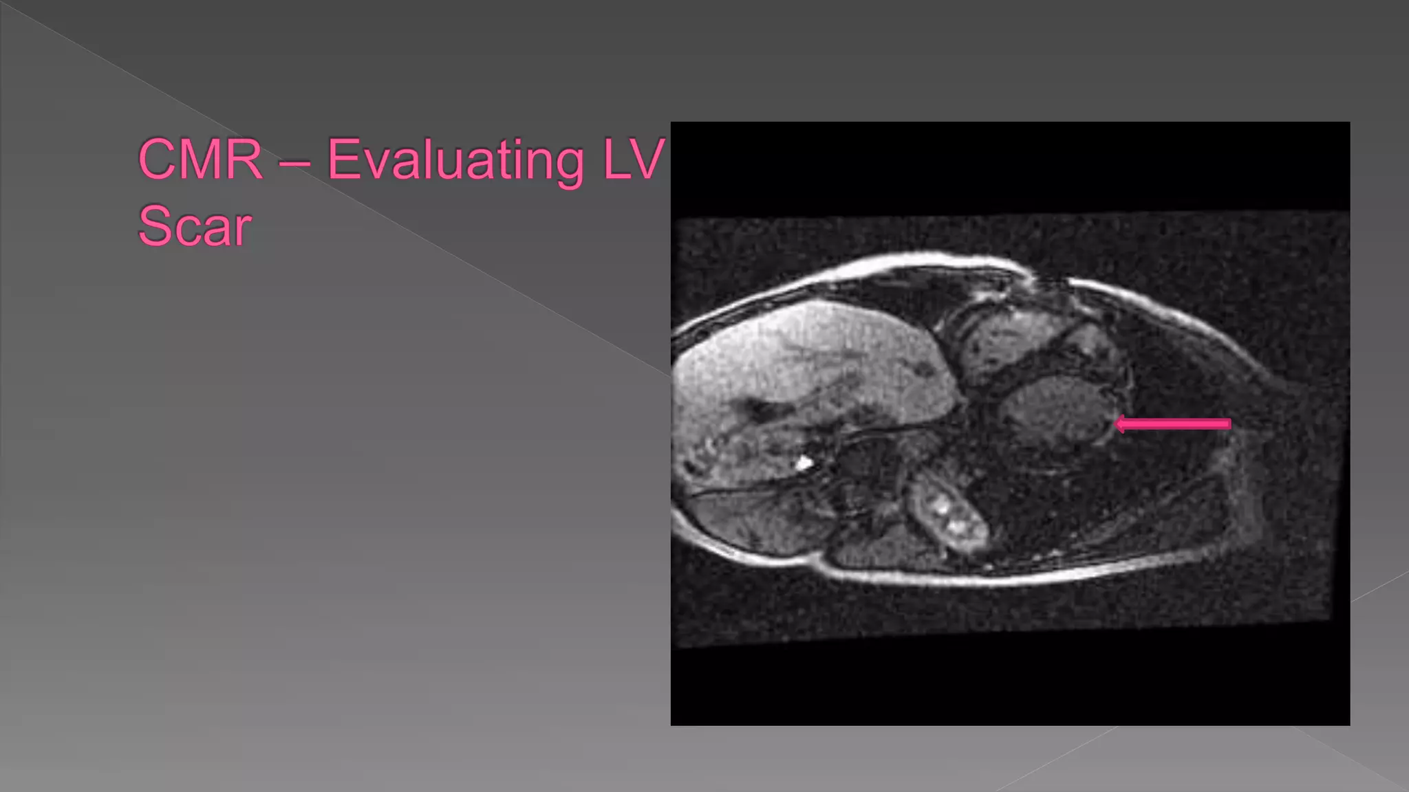 ALCAPA AND TAKEUCHI PROCEDURE | PPTX | Heart and Cardiovascular ...