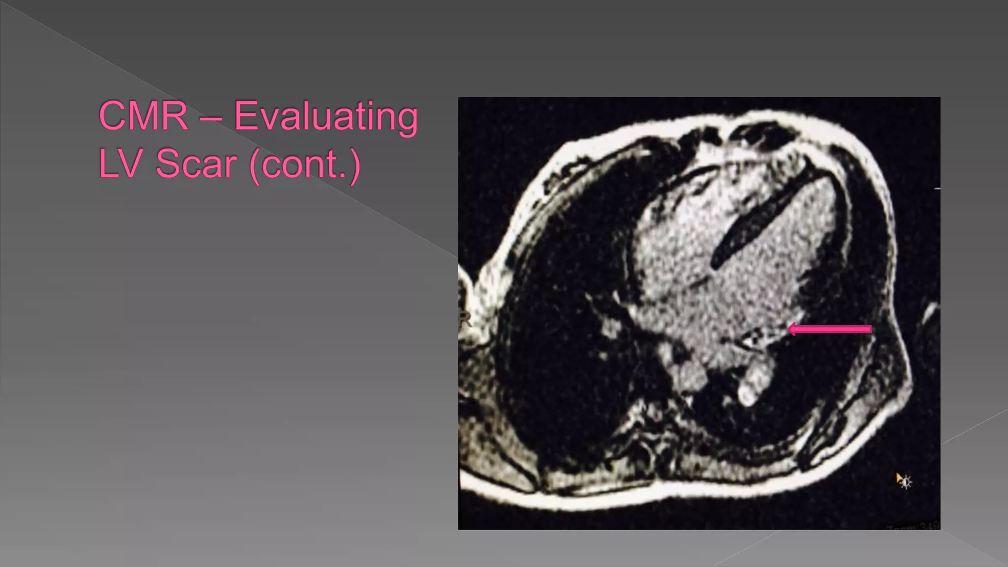 ALCAPA AND TAKEUCHI PROCEDURE | PPTX | Heart and Cardiovascular ...