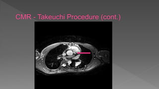 ALCAPA AND TAKEUCHI PROCEDURE | PPTX | Heart and Cardiovascular ...