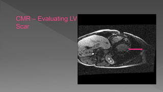 ALCAPA AND TAKEUCHI PROCEDURE | PPTX | Heart and Cardiovascular ...