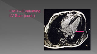 ALCAPA AND TAKEUCHI PROCEDURE | PPTX | Heart and Cardiovascular ...