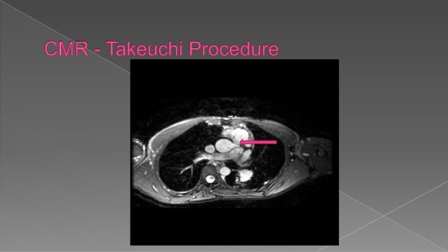 ALCAPA AND TAKEUCHI PROCEDURE
