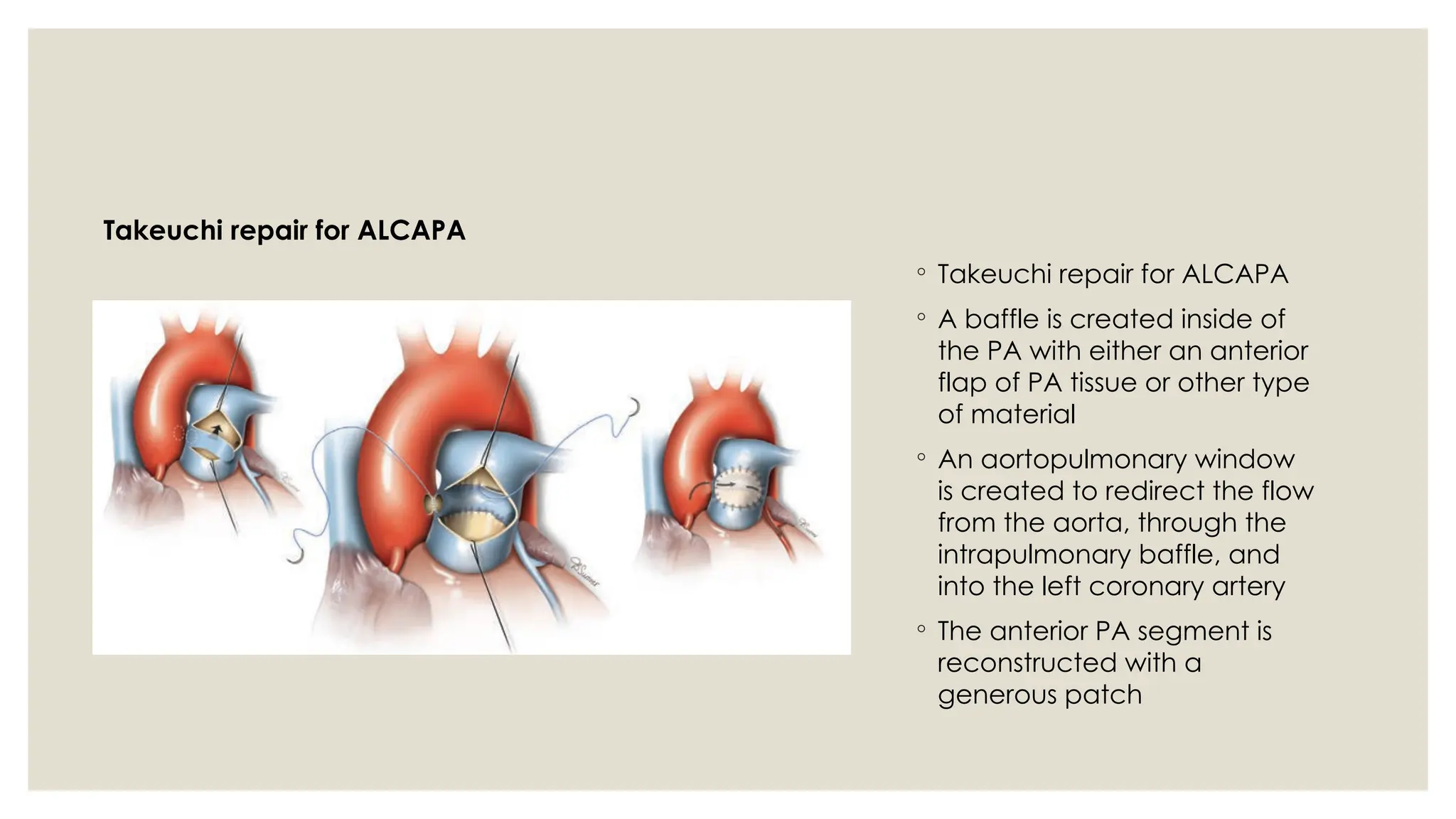 Anomalous origin of the left coronary artery from the pulmonary artery ...