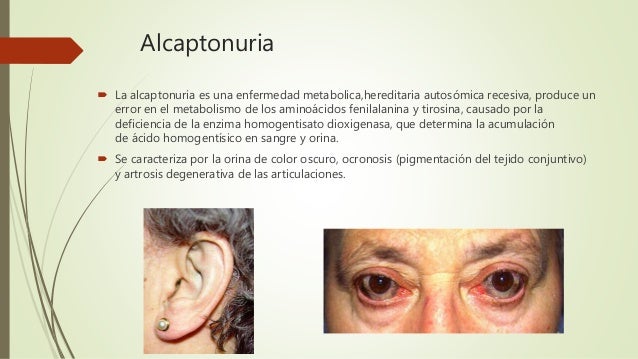 Alcaptonuria
