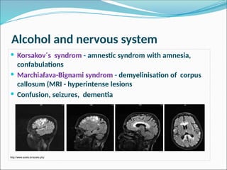 Neurological complications of alcoholism | PPT
