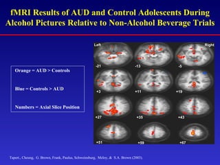 Alcohol & Adolescent Brain Development | PPT