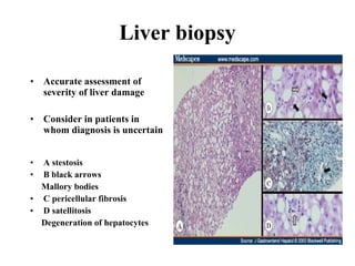 Alcoholic Hepatitis | PPT