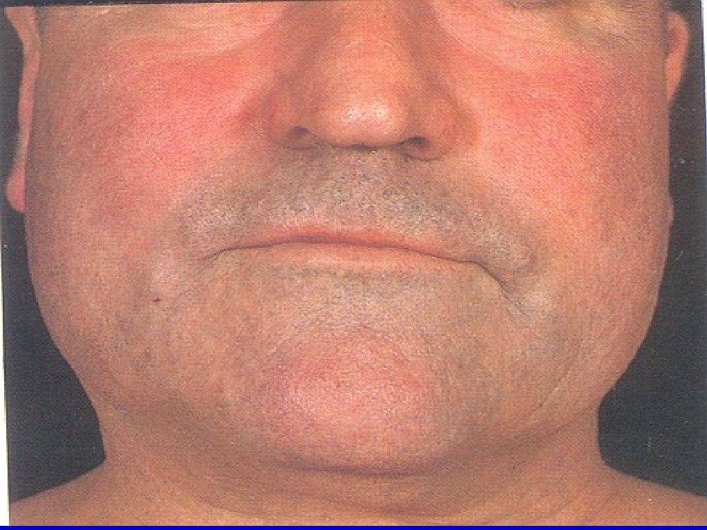 Alcoholic Liver Disease
