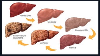 ALCOHOLIC and LIVER DISEASE.pptx