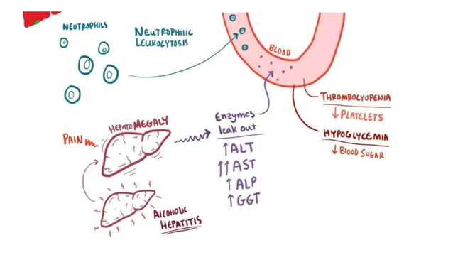 ALCOHOLIC LIVER DISEASE. By Dr. fatima nasir FMC jabi | PPT