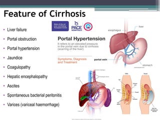 Alcoholic Liver Disease Cirrhosis Jwu Pptx