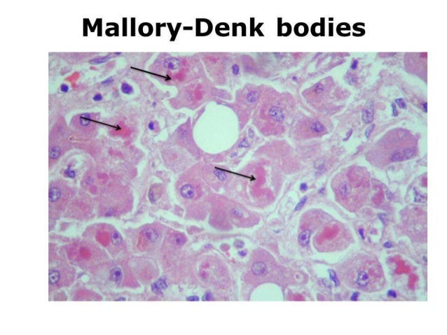 Alcoholic liver disease mbbs