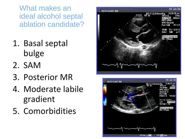 Alcoholic septal ablation | PPT