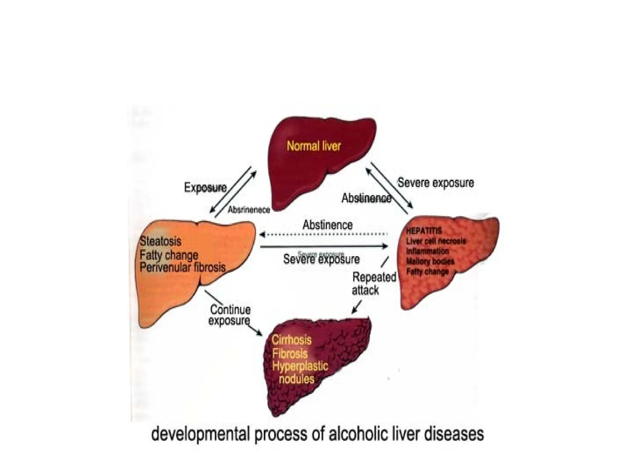 Alcohol liver disease : causes , pathophysiology and its management | PPT