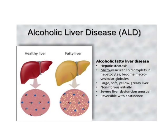 Alcohol liver disease : causes , pathophysiology and its management | PPT