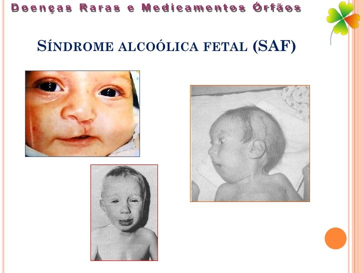 Alcoolica fetal