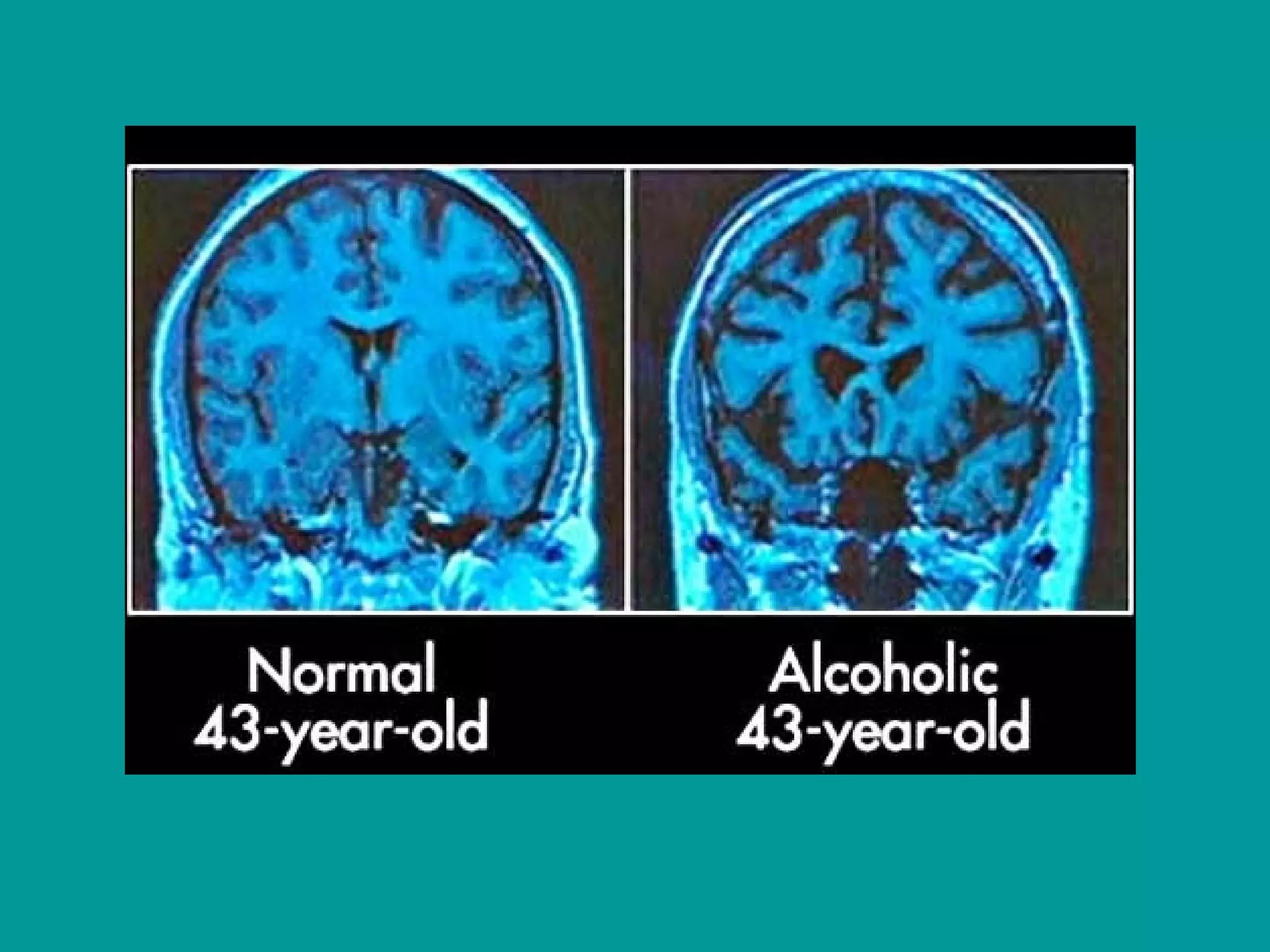Alcoolul, proiect la chimie | PPT