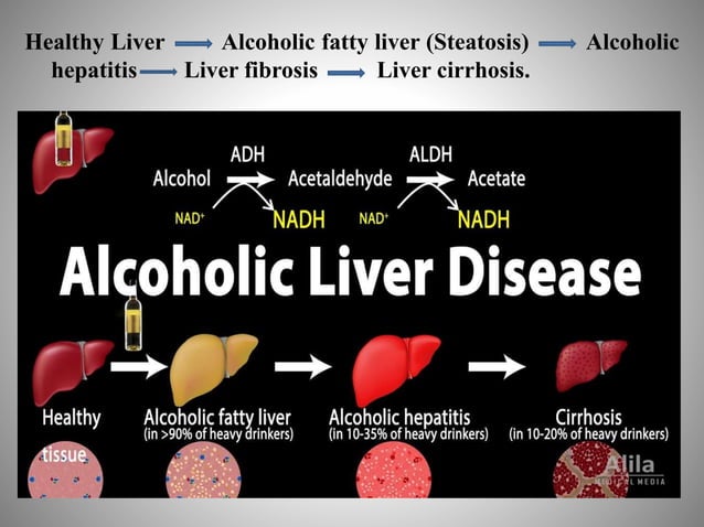 Pathophysiology of Alcoholic Liver Disease.pptx | Digestive Disorders ...