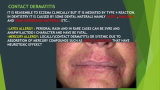 Allergy and autoimmune diseases in dentistry | PPTX