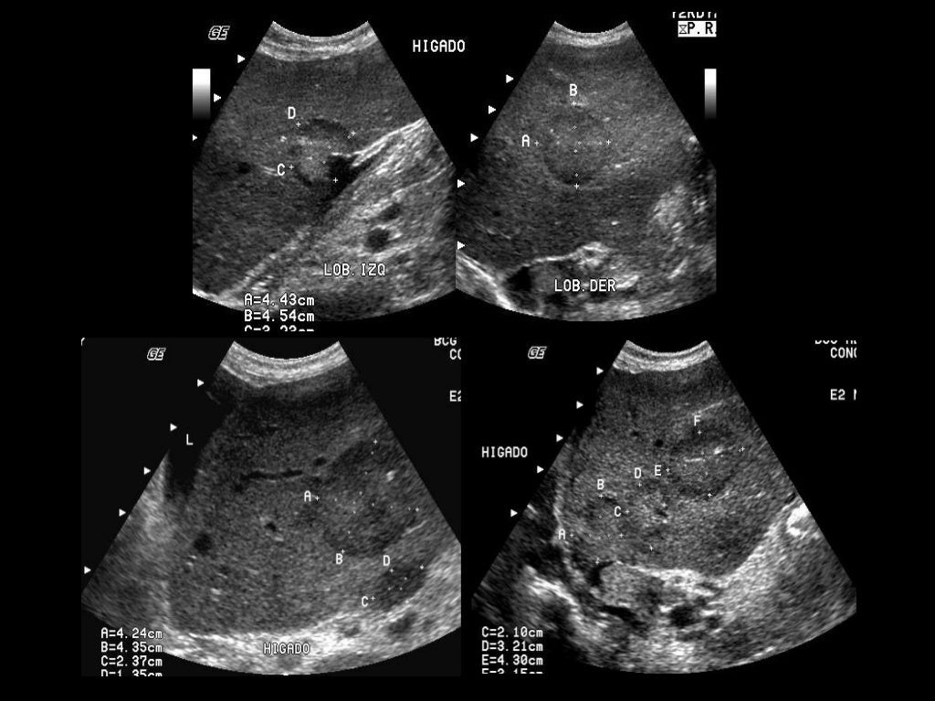 LESIONES FOCALES HEPATICAS EN ULTRASONIDO