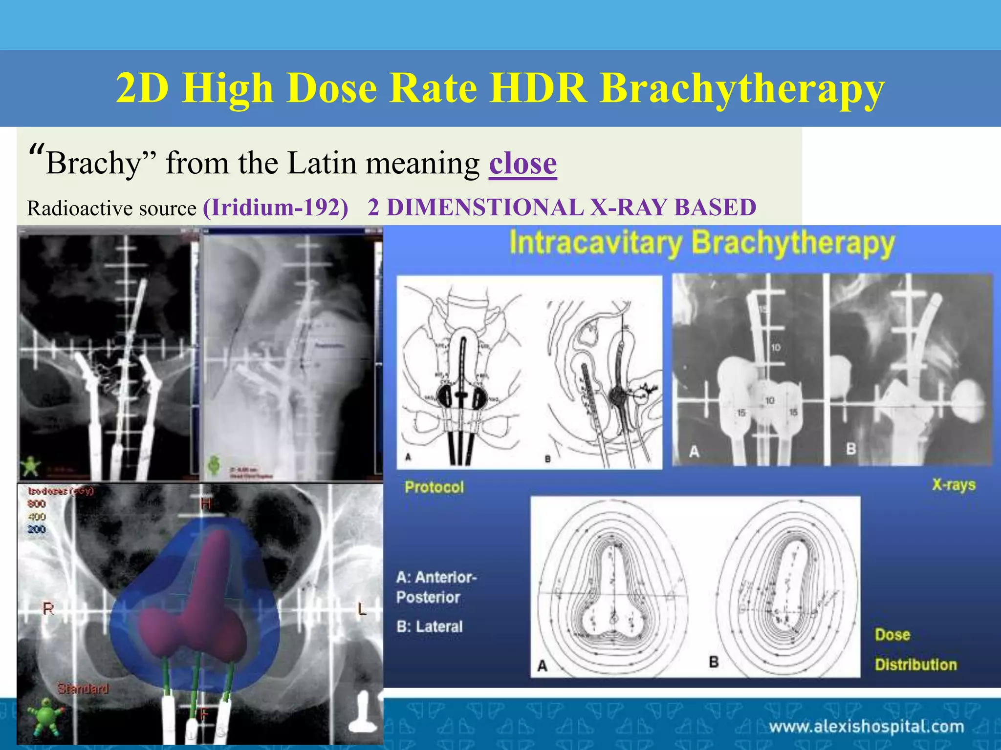 Brachytherapy IGABT | PPTX