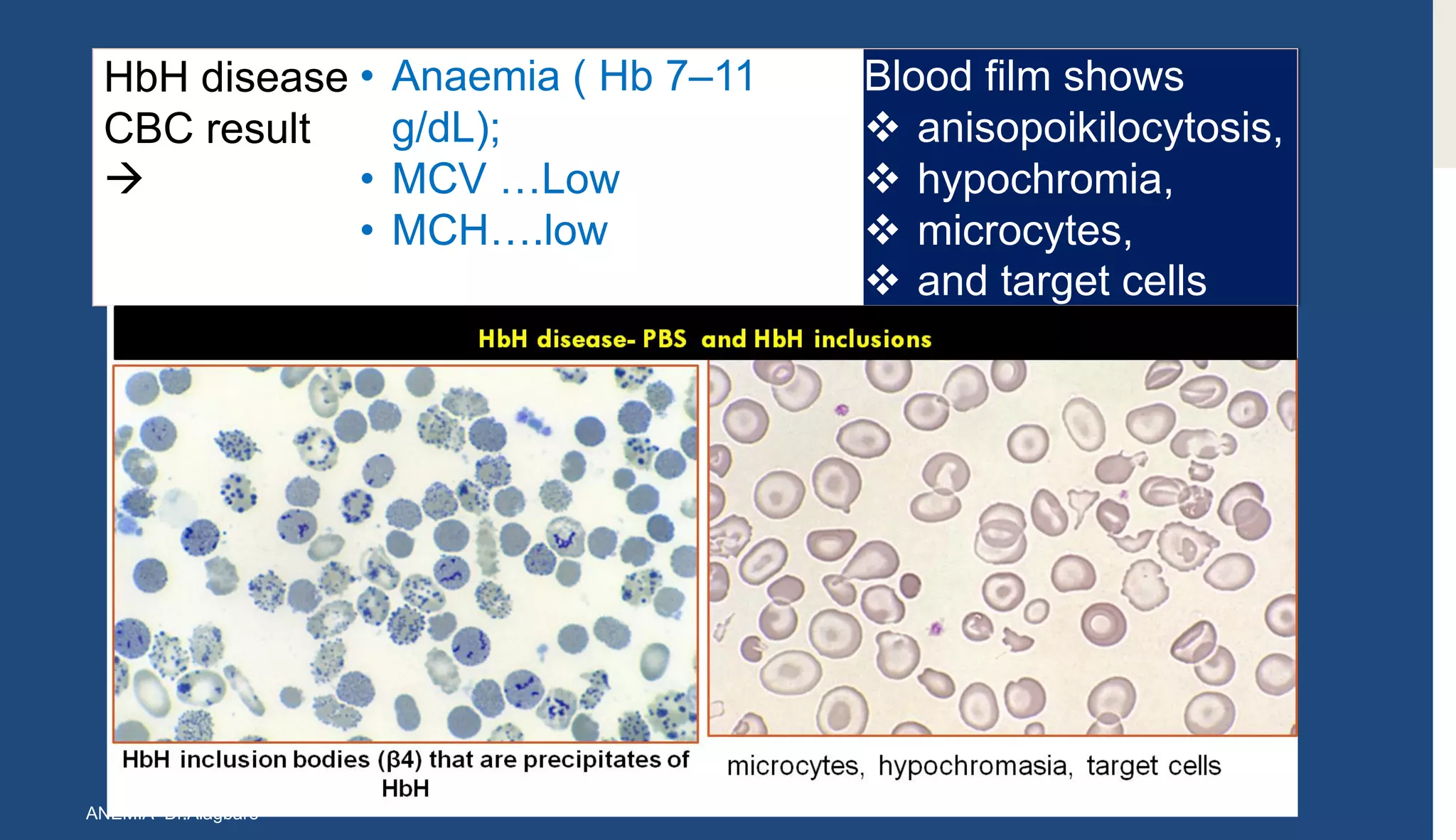 Alfa thalassemia syndromes | PDF