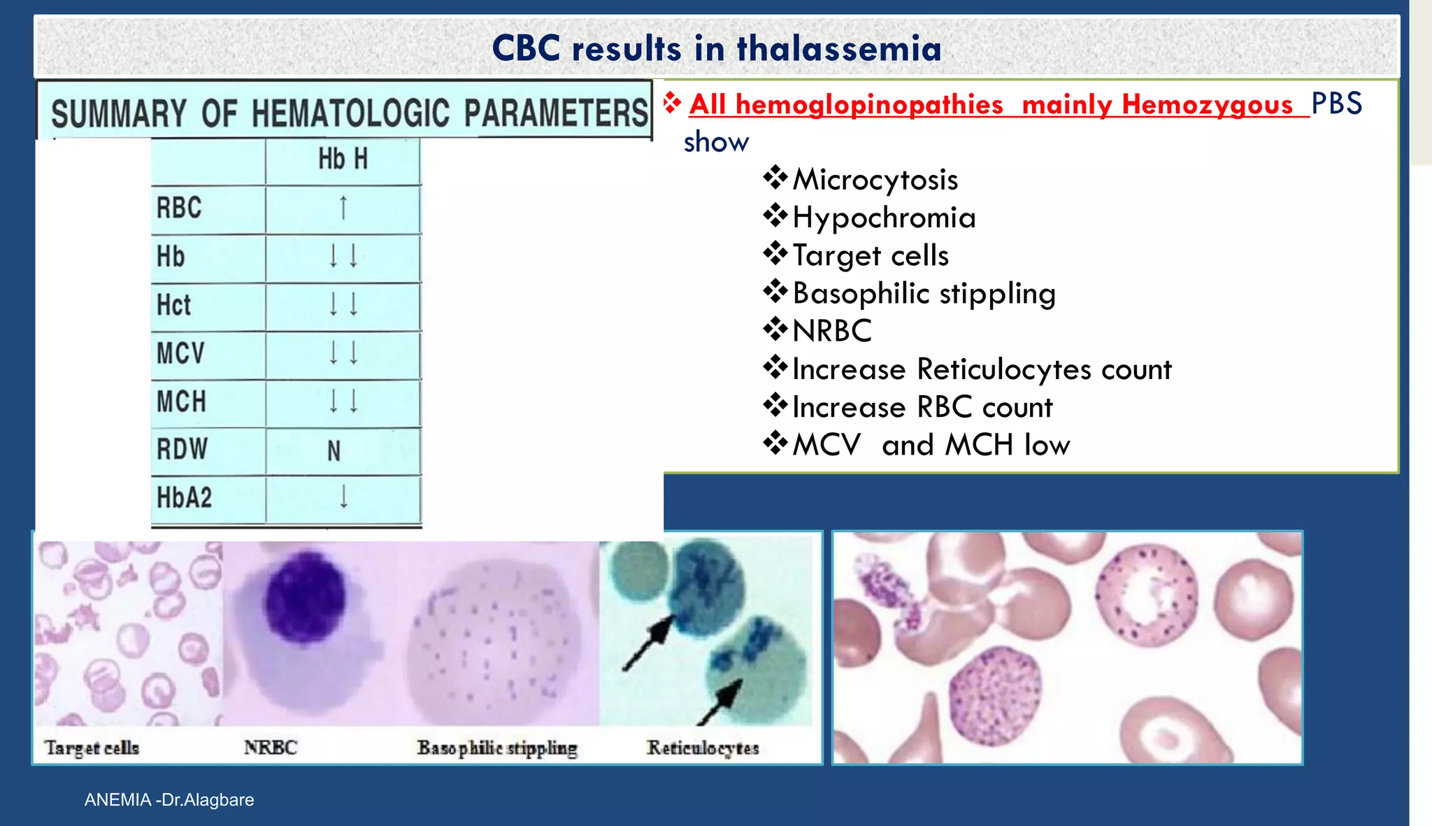 Alfa thalassemia syndromes | PDF