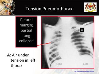 ALS Algorithm lecture | PDF